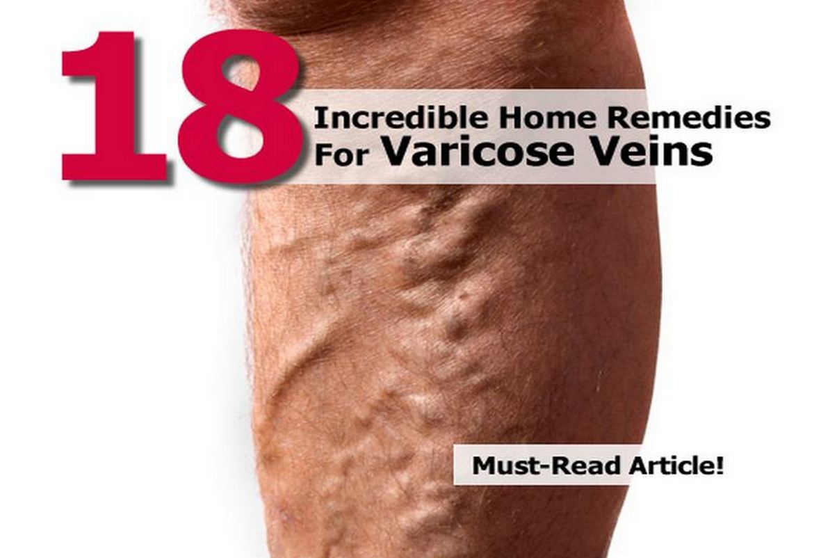 18 Incredible Home Remedies For Varicose Veins